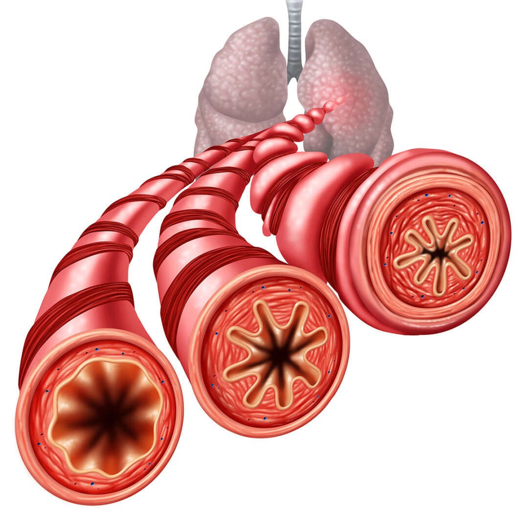 Asthma - Lunge Vital - Jalal Gholami